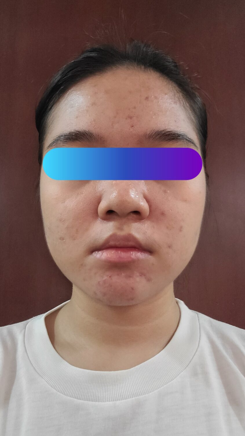 Acnetame Acne Pills Supplement- Ingredients, Side Effects & Reviews