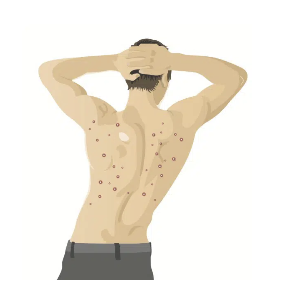 Face & Body Acne Map: Decode the Meaning of Your Breakouts